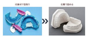 新しいデジタルな歯型取り【光学印象】とは？